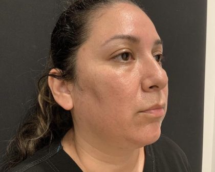 Patient #6342 Submental Liposuction Before and After Photos Austin, TX ...