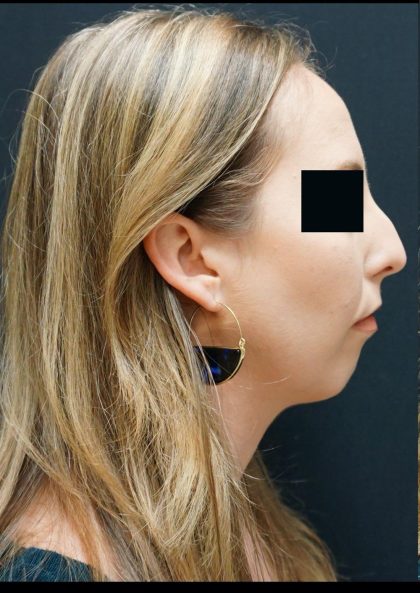 Patient #8072 Liquid Rhinoplasty Before and After Photos Austin, TX ...