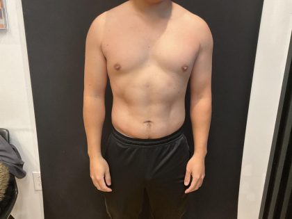 Patient #8184 High Definition Liposuction Before and After Photos ...