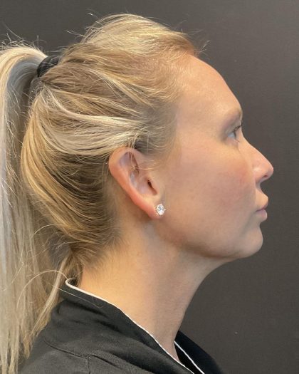 Patient #8139 MyEllevate Before and After Photos Austin, TX - Plastic ...