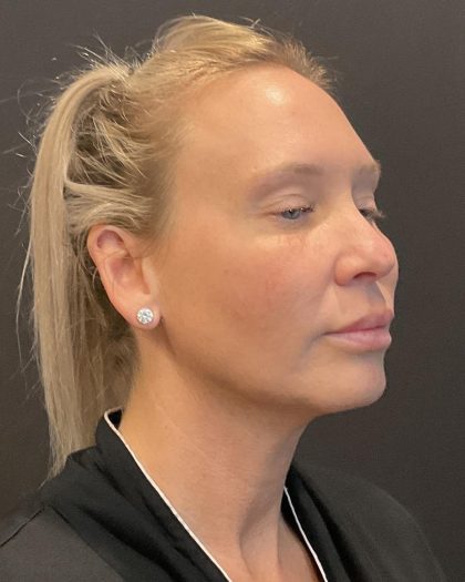 Patient #8139 MyEllevate Before and After Photos Austin, TX - Plastic ...