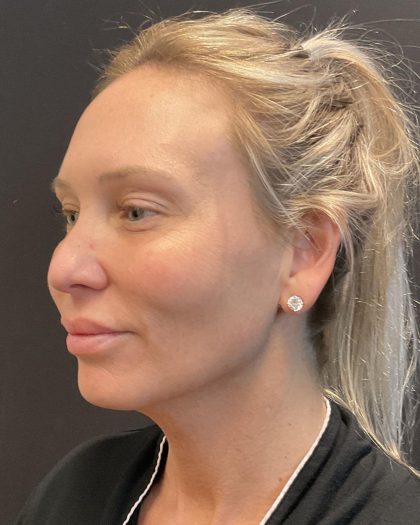 Patient #8139 MyEllevate Before and After Photos Austin, TX - Plastic ...