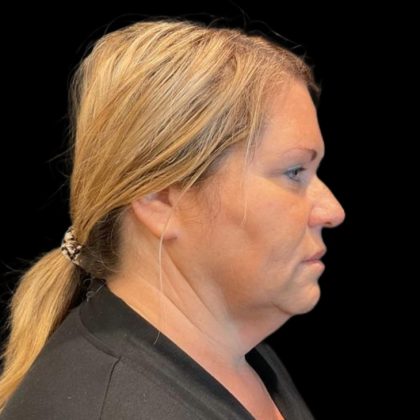 Patient #8144 MyEllevate Before and After Photos Austin, TX - Plastic ...