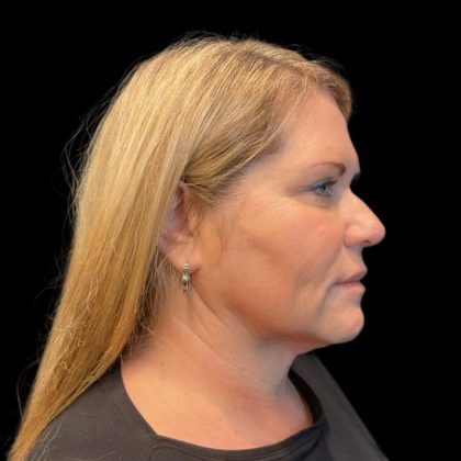 Patient #8144 MyEllevate Before and After Photos Austin, TX - Plastic ...