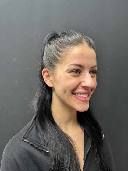 Patient #8083 Neurotoxin Before and After Photos Austin, TX - Plastic ...