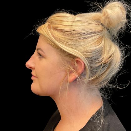 Patient #9501 MyEllevate Before and After Photos Austin, TX - Plastic ...