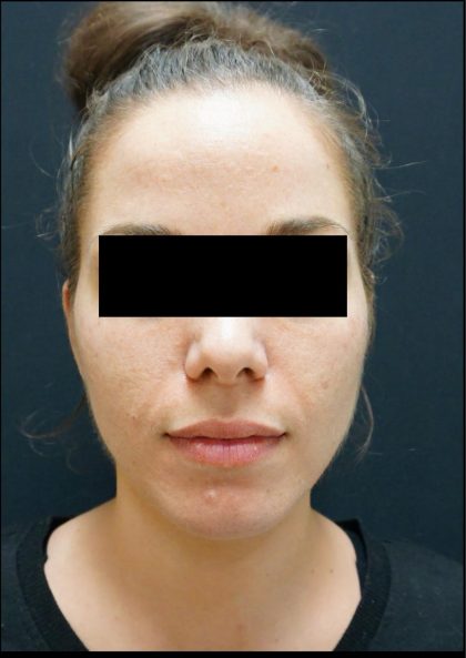 Patient #8416 Before and After Photos Austin, TX - Plastic Surgery ...